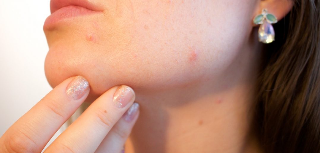 Dealing with Zits, Acne and Pimples - School Mum
